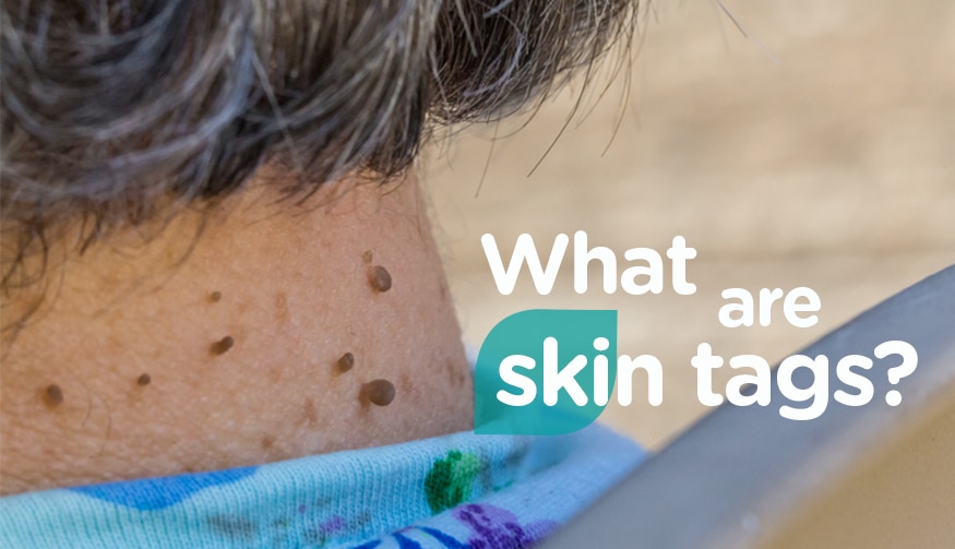 What are skin tags & How to get rid of them? | Watsons Philippines
