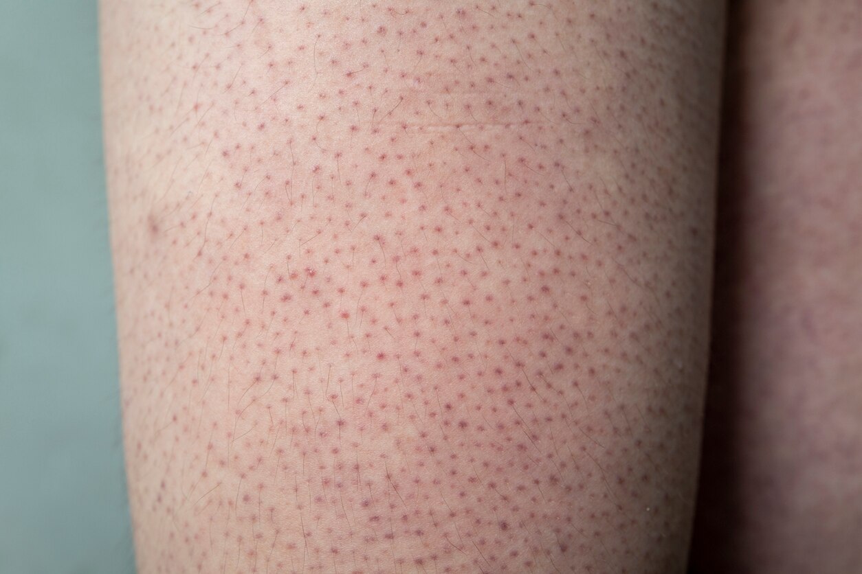 Strawberry Legs Causes And How To Get Rid Of Them Watsons Philippines Strawberry Legs Causes And How To Get Rid Of Them Watsons Philippines
